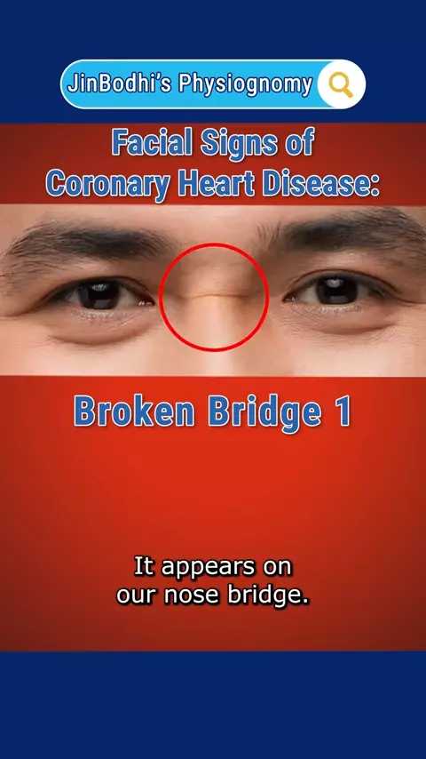 A wrinkle on the nose bridge can be a sign of heart problems ...